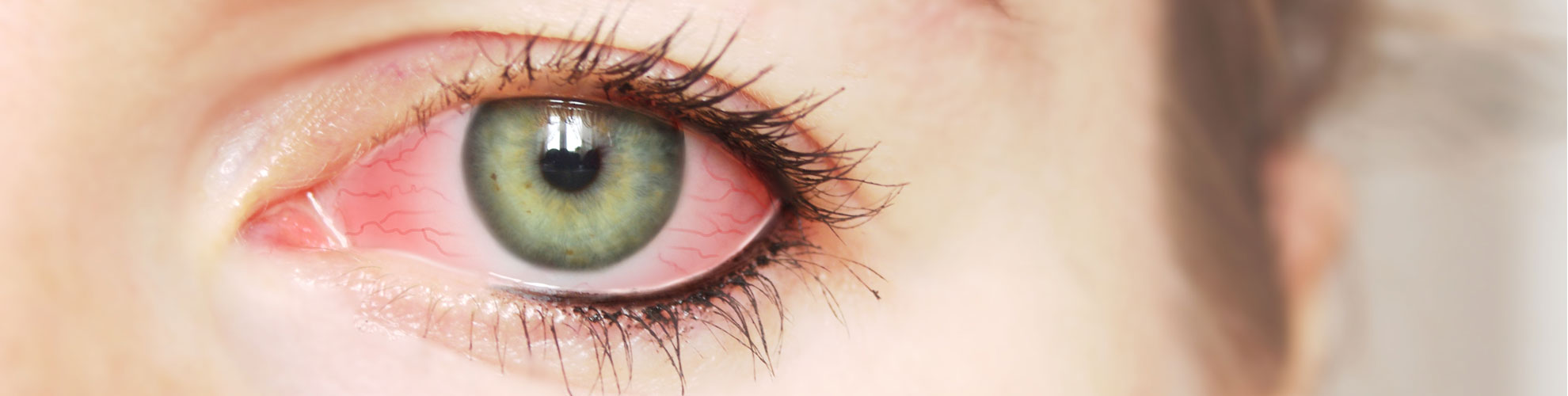 Conjunctivitis - Elevation EyeWorks